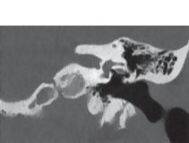 Coronal CT Reconstruction of the Left Temporal Bone