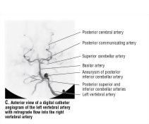 Anterior View of a Digital Catheter Angiogram of the Left Vertebral Artery