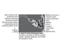 Axial CT of the Left Temporal Bone