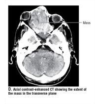 Axial Contrast-Enhanced CT Showing the Extent of the Mass In the ...