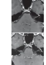 Imaging of Bell Palsy