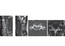 Imaging of Ossification of Posterior Longitudinal Ligament (OPLL)