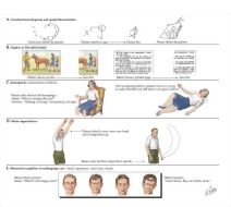 Nondominant Hemisphere Higher Cortical Dysfunction