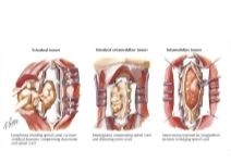 Myelographic and CT Characteristics of Spinal Tumors