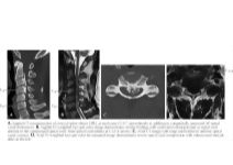 Imaging of Ossification of Posterior Longitudinal Ligament (OPLL)