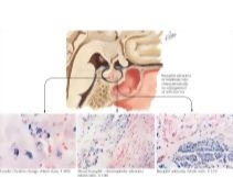 Basophilic Adenoma Cushing Disease