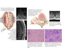 Intradural Extramedullary Primary Spinal Tumors