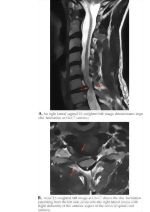 Large Right Lateral C6-C7 Disc Herniation