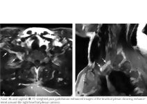 Parsonage-Turner Brachial Plexitis