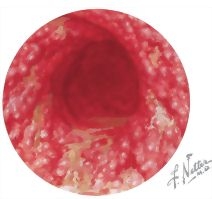 Proctocolitis; Proctocolitis Hemorrágica; Proctocolitis Ulcerosa ...