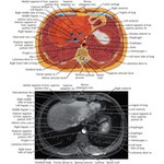 Abdomen Axial 1