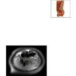 Peritoneal Cavity Abdomen Coronal 1