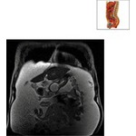 Peritoneal Cavity Abdomen Coronal 3