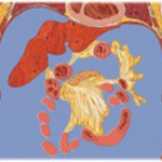 Peritoneal Cavity Abdomen Coronal 4