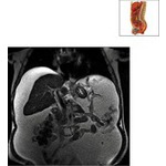 Peritoneal Cavity Abdomen Coronal 6