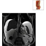 Peritoneal Cavity Abdomen Coronal 7