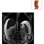 Peritoneal Cavity Abdomen Coronal 8