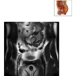 Male Pelvis Coronal 2