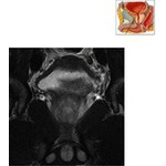 Prostate and Seminal Tract Coronal 1