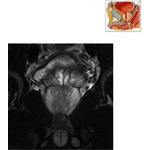Prostate and Seminal Tract Coronal 2