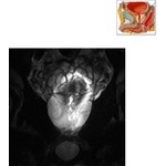 Prostate and Seminal Tract Coronal 5