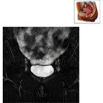 Female Pelvis Coronal 2