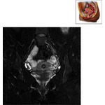 Female Pelvis Coronal 6