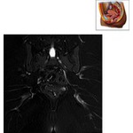 Female Pelvis Coronal 10