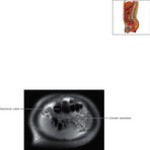 Peritoneal Cavity Abdomen Coronal 1