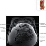 Peritoneal Cavity Abdomen Coronal 2