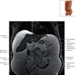 Peritoneal Cavity Abdomen Coronal 4