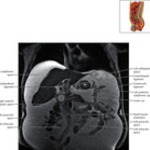 Peritoneal Cavity Abdomen Coronal 5