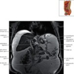 Peritoneal Cavity Abdomen Coronal 6