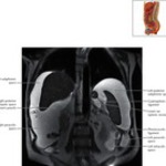 Peritoneal Cavity Abdomen Coronal 8