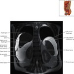 Peritoneal Cavity Abdomen Coronal 9