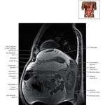 Peritoneal Cavity Pelvis Sagittal 2