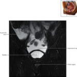 Peritoneal Cavity Pelvis Coronal 2