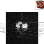 Peritoneal Cavity Pelvis Coronal 6