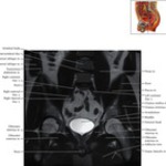 Male Pelvis Coronal 5