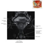 Prostate and Seminal Tract Coronal 1
