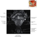 Prostate and Seminal Tract Coronal 2