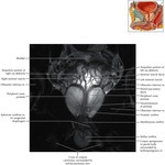 Prostate and Seminal Tract Coronal 3