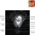 Prostate and Seminal Tract Coronal 4