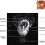 Prostate and Seminal Tract Coronal 5