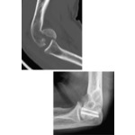 Capitellum Fractures