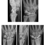 Dislocation of Carpus: Radiology