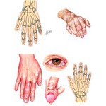 Hand Involvement in Gouty Arthritis and Reiter Syndrome