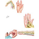 Trigger Finger and Jersey Finger