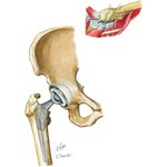 Total Hip Replacement: Steps 19 and 20