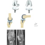 Knee Arthroplasty: Total Condylar Prosthesis and Unicompartmental ...